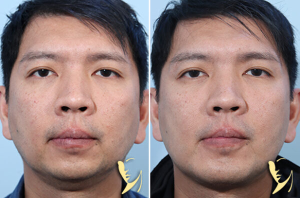 Submental Lipectomy with Platysmaplasty Gallery