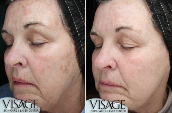 BBL | Broadband Light Therapy | Atlanta, GA | Dr. Burke Robinson