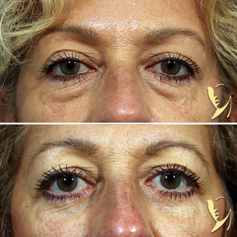 Lower Eyelids Blepharoplasty Before After 60 close up | Robinson FPS