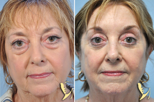 Upper Lower Eyelids Blepharoplasty Before After 70 | Robinson FPS
