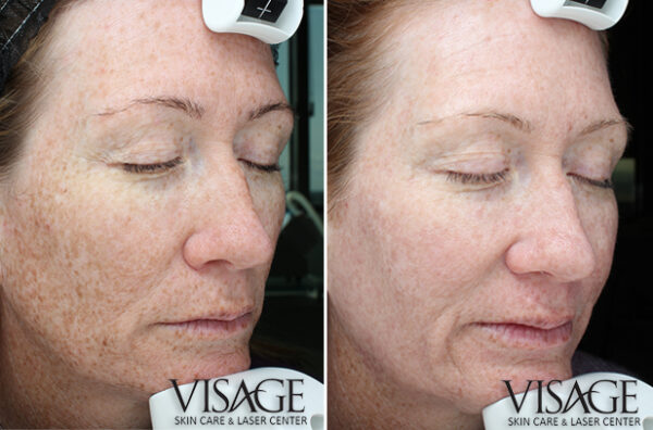 BBL & Forever Young BBL: Everything to know about these light therapy ...