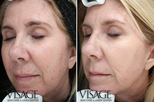 BBL | Broadband Light Therapy | Atlanta, GA | Dr. Burke Robinson