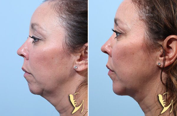 Chin Implant Before and After Gallery | Atlanta, GA | Dr. Burke Robinson