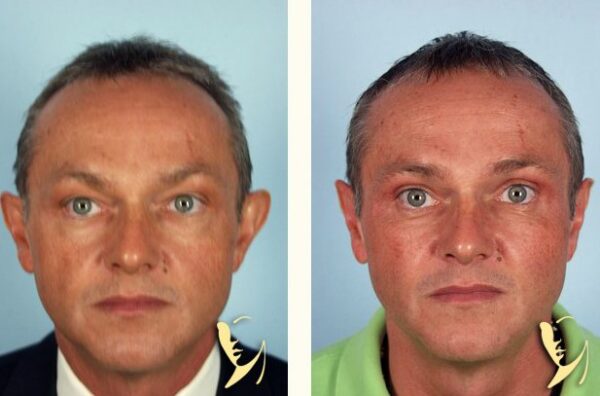 Ear Surgery Before and After Gallery | Atlanta, GA | Dr. Burke Robinson