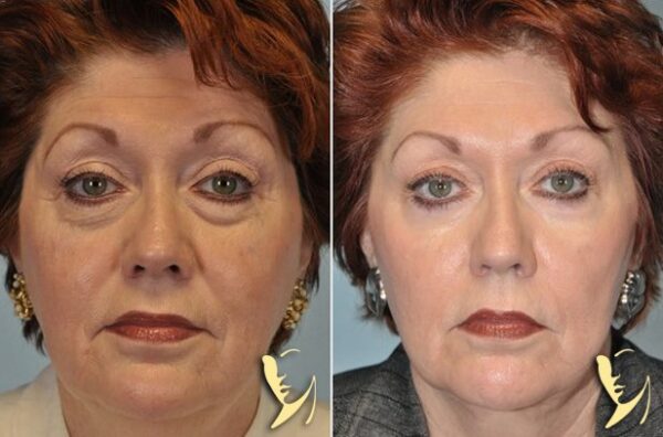 Lower Eyelid Before and After Gallery | Atlanta, GA | Dr. Burke Robinson