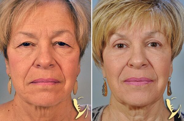 Lower Eyelid Before and After Gallery | Atlanta, GA | Dr. Burke Robinson