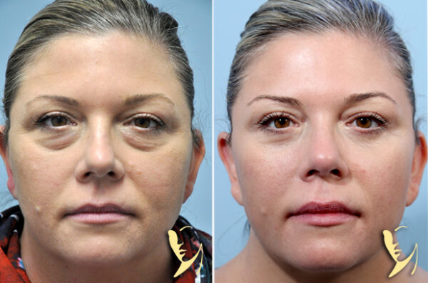Lower Eyelid Before and After Gallery | Atlanta, GA | Dr. Burke Robinson