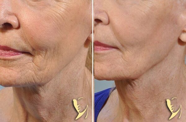 Take Years of Your Face with Profound Skin Tightening | Dr. Burke Robinson